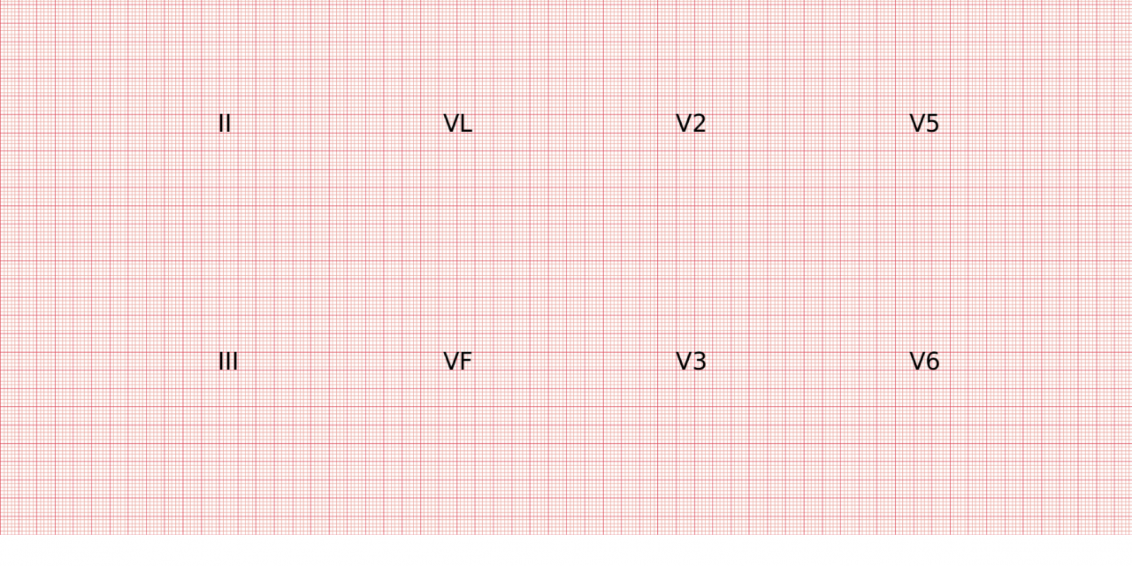 Introduction to the ECG | MedGuide